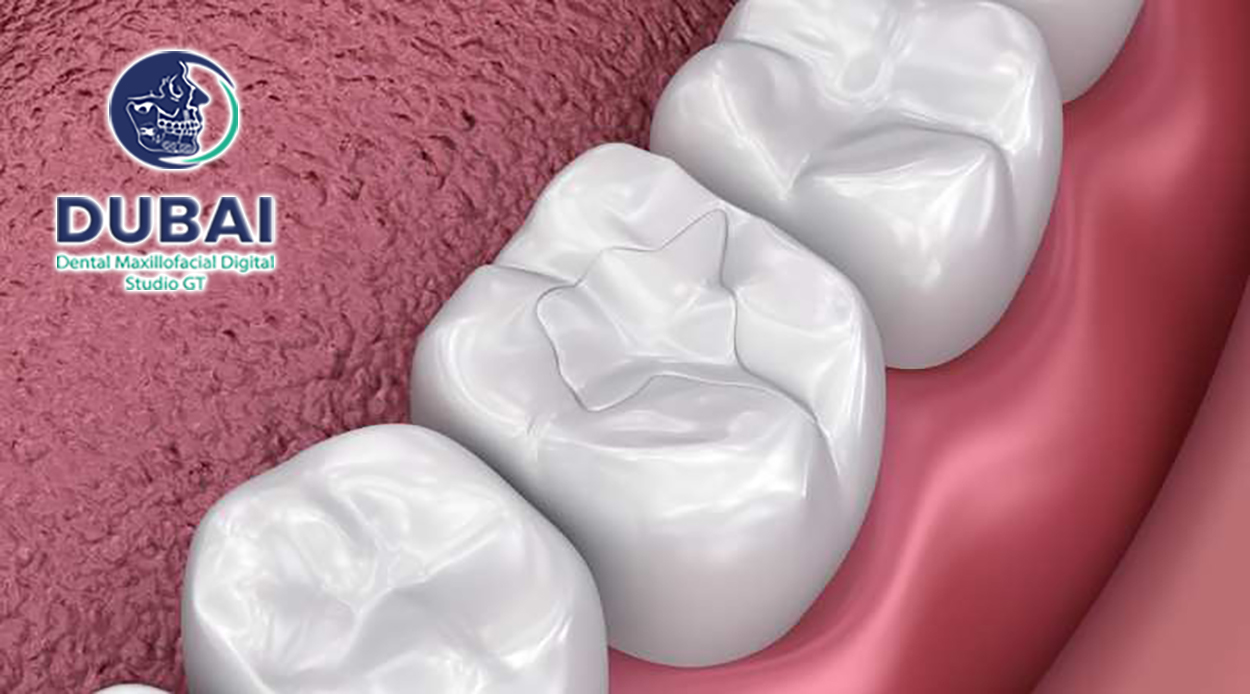 Rellenos de resina - Dubai Dental Studio